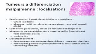 Vidéothèque de l'UL - Anapath Ue1 Fgsm2 - 08 - Tumeurs Épithéliale…
